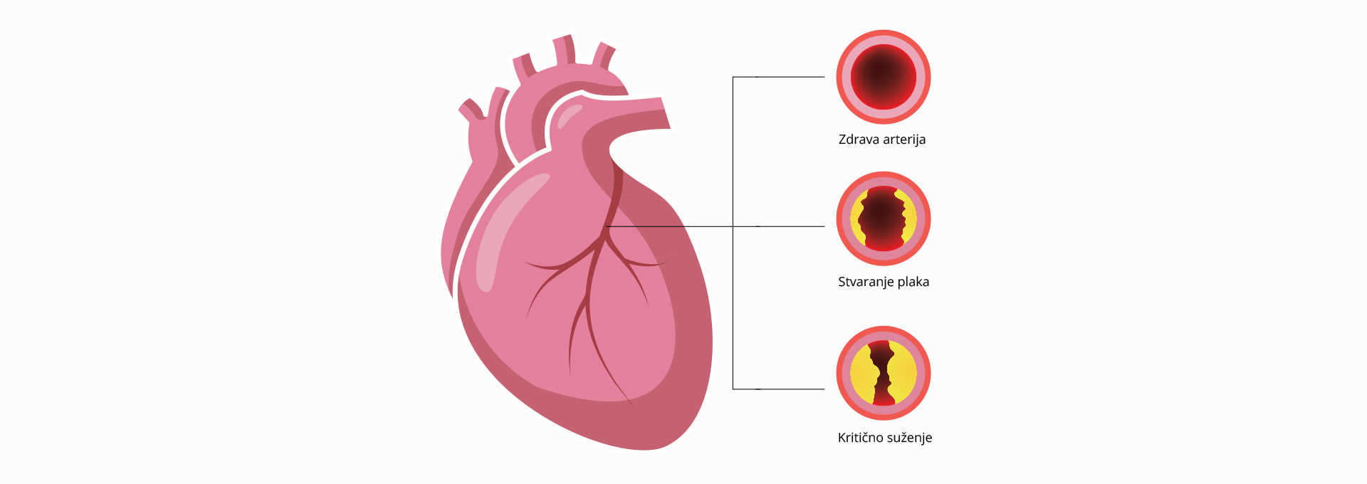 Kardiovaskularne bolesti: Koronarna bolest srca